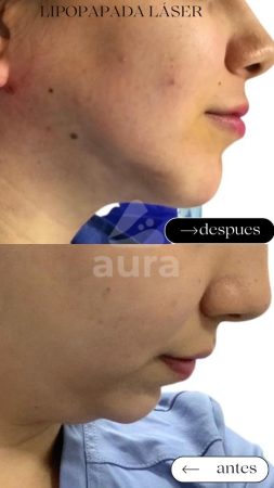 Endolifting – Centro Médico Aura