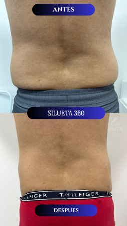 Endolifting – Centro Médico Aura